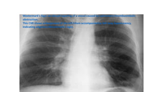 Pulmonary embolism | PPTX | Blood Disorders | Diseases and Conditions