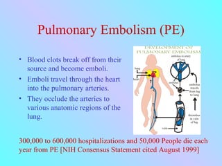 Pulmonary embolism | PPT