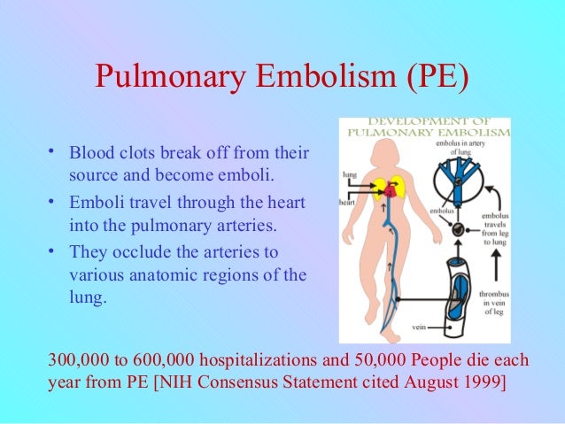 Pulmonary embolism