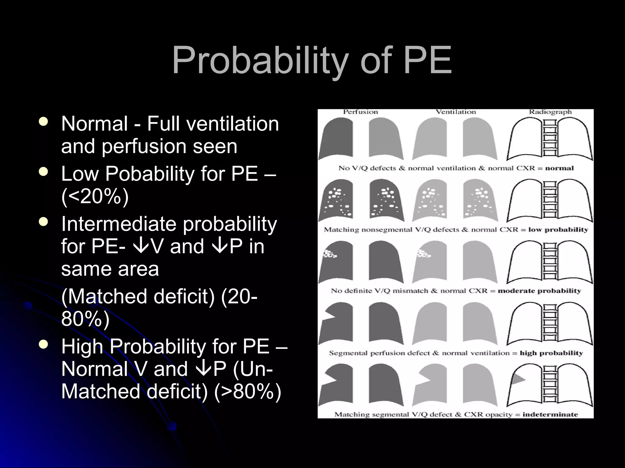 Pulmonary Embolism - (PE) | PPT