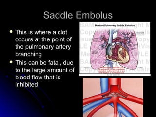 Pulmonary Embolism - (PE) | PPT