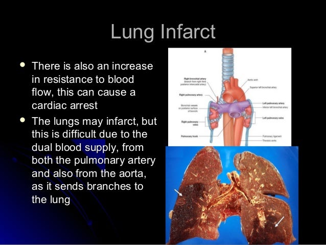 Pulmonary Embolism Perc