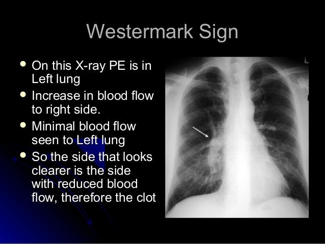 Pulmonary Embolism - (PE)