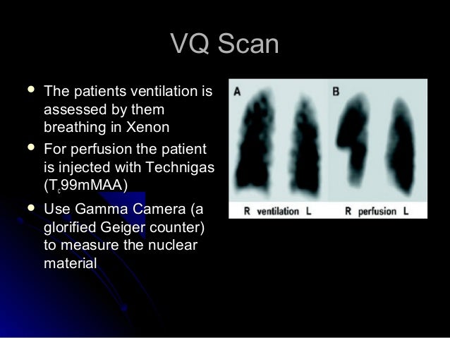 Pulmonary Embolism - (PE)