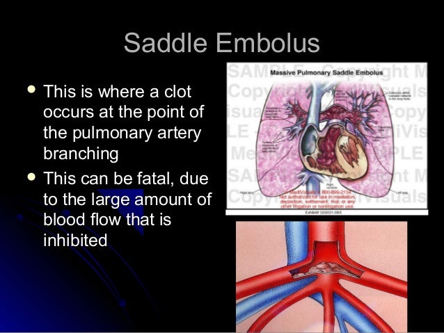 Pulmonary Embolism Perc