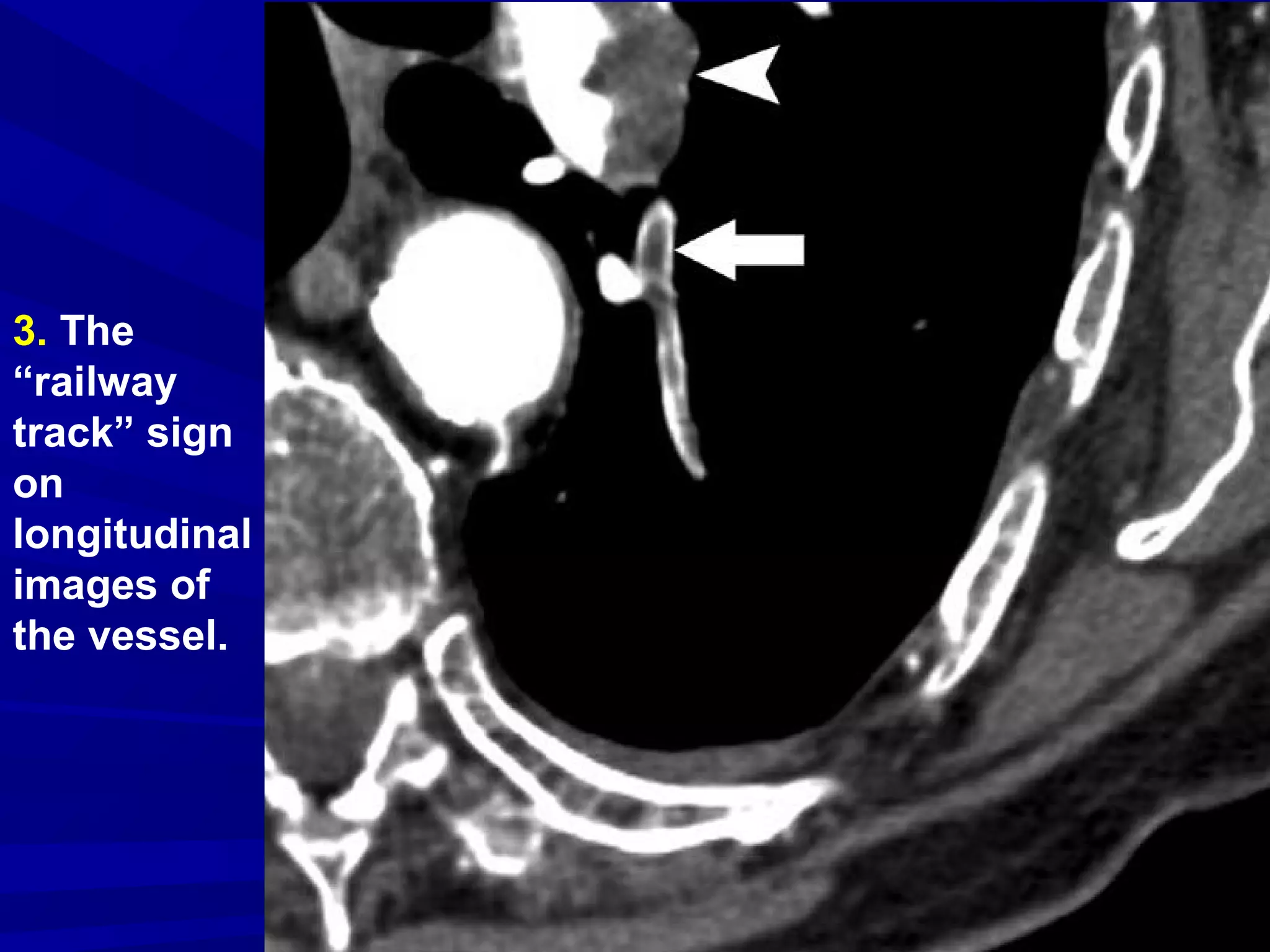 Pulmonary embolism | PPT