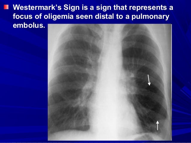 Pulmonary embolism