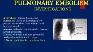 Pulmonary embolism- Venous diseases | PPT