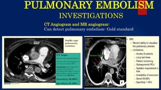 Pulmonary embolism- Venous diseases | PPT