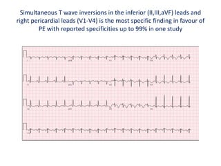 Pulmonary embolism | PPTX