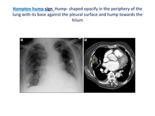 Pulmonary embolism | PPTX