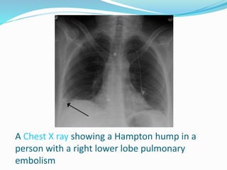 Pulmonary embolism | PPTX