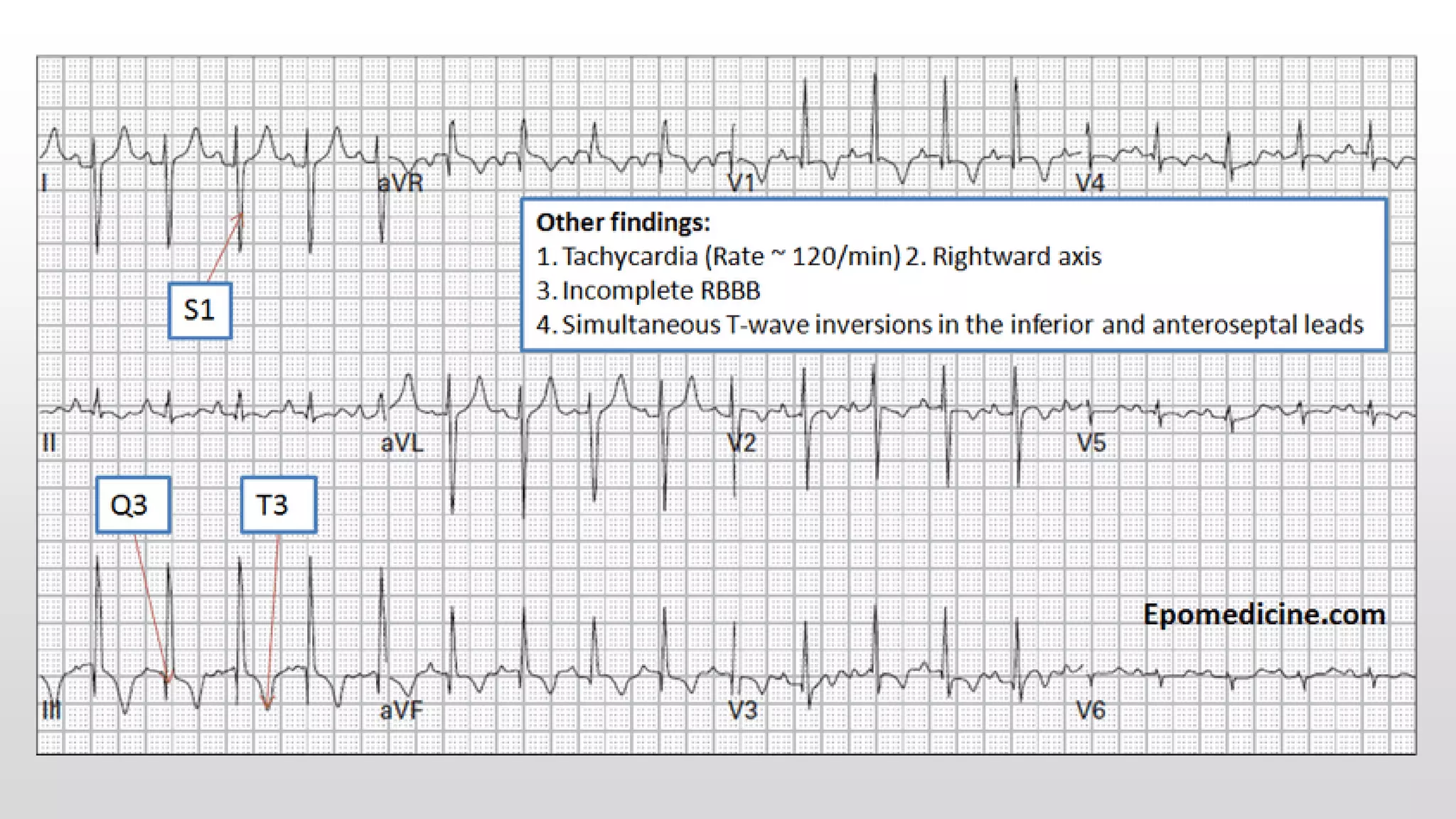 Revisiting Pulmonary embolism Guidelines | PDF | Heart and ...