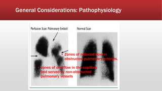 Revisiting Pulmonary embolism Guidelines | PDF