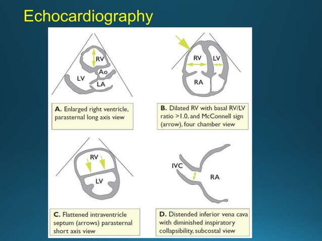 Pulmonary embolism - 2019 ESC Guidelines by Dr. Vaibhav Yawalkar MD DM ...