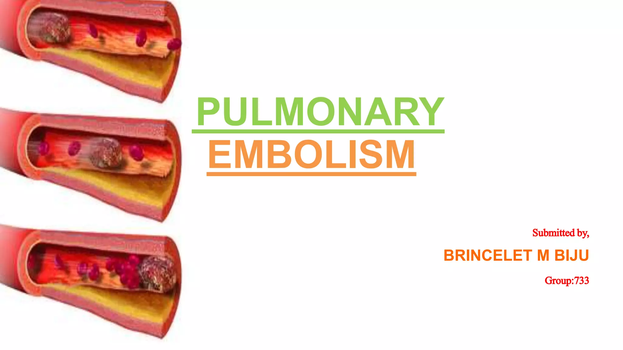 Pulmonary Embolism Ppt
