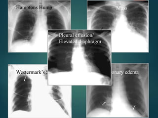 PULMONARY EMBOLISM.pptx