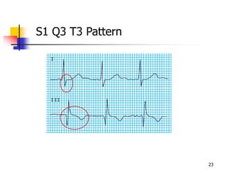Pulmonary Embolism.ppt
