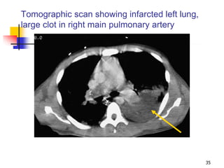 Pulmonary Embolism.ppt