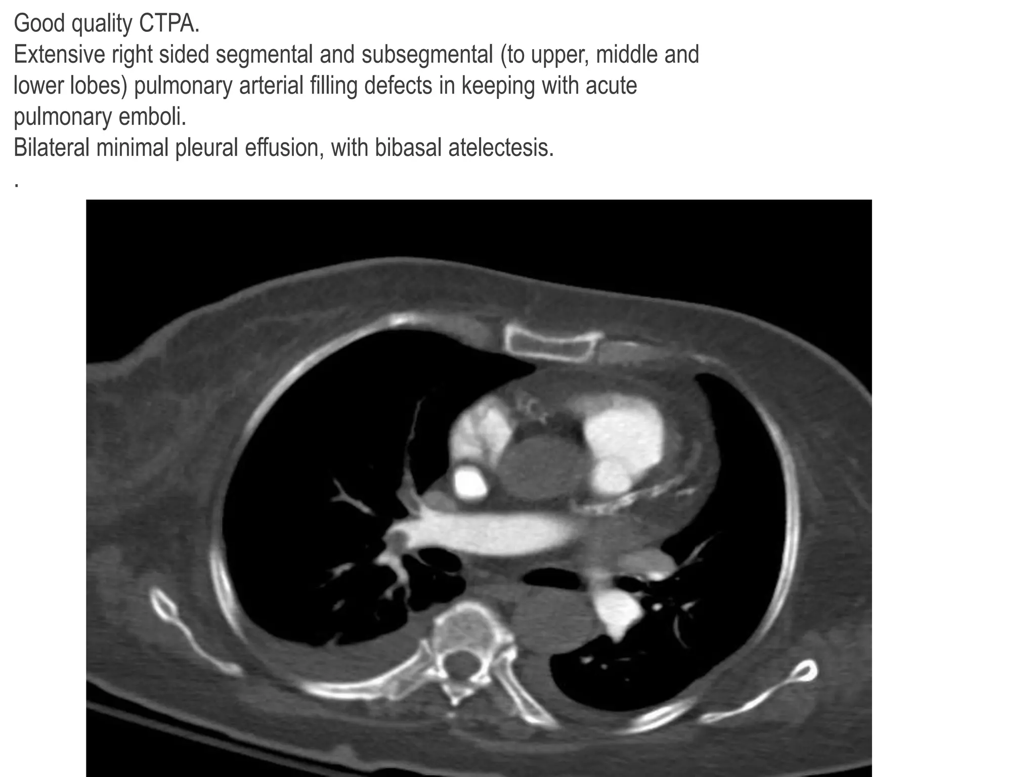 Pulmonary Embolism | PPTX