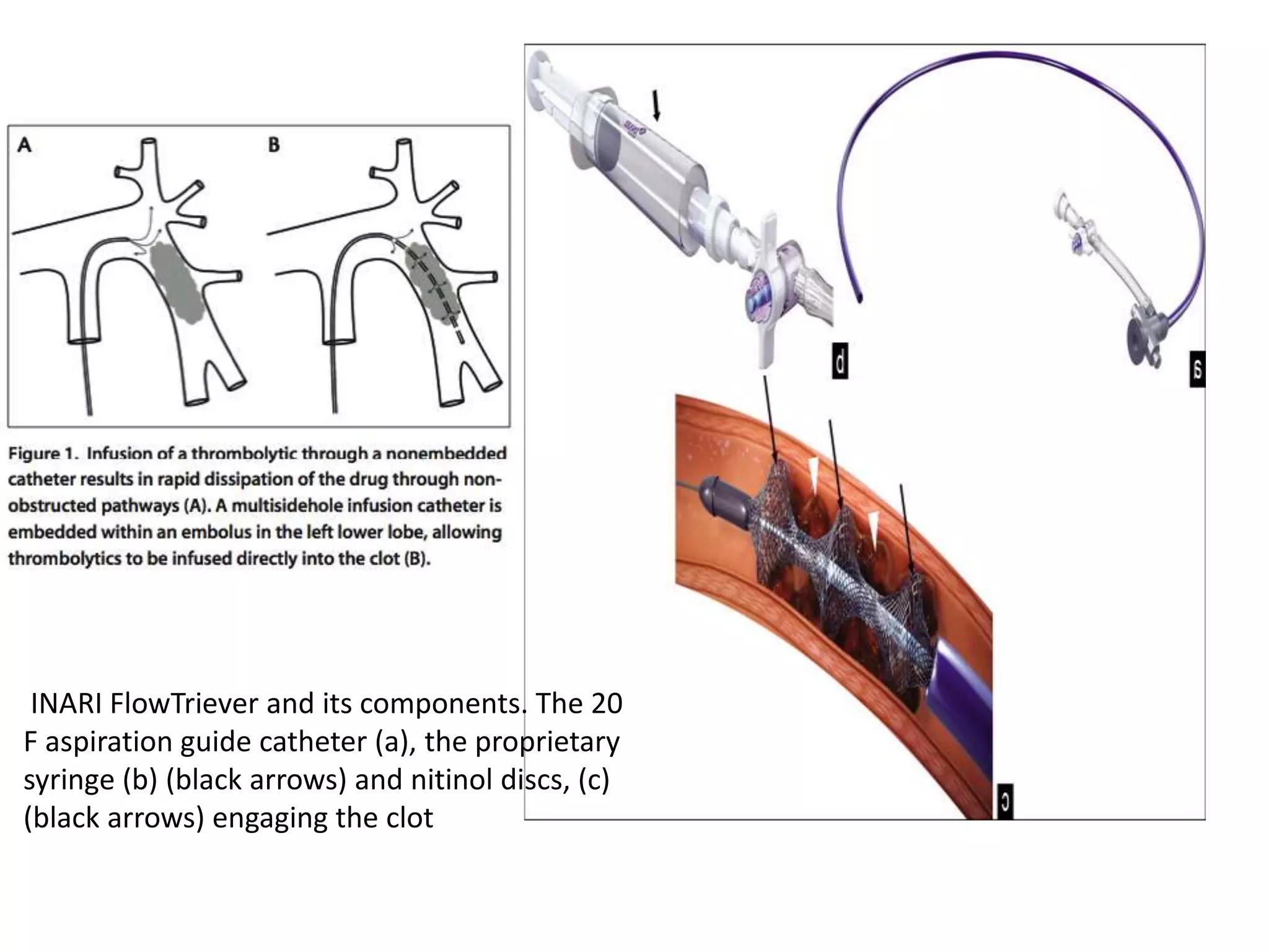 Pulmonary Embolism | PPTX