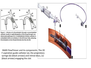Pulmonary Embolism | PPTX