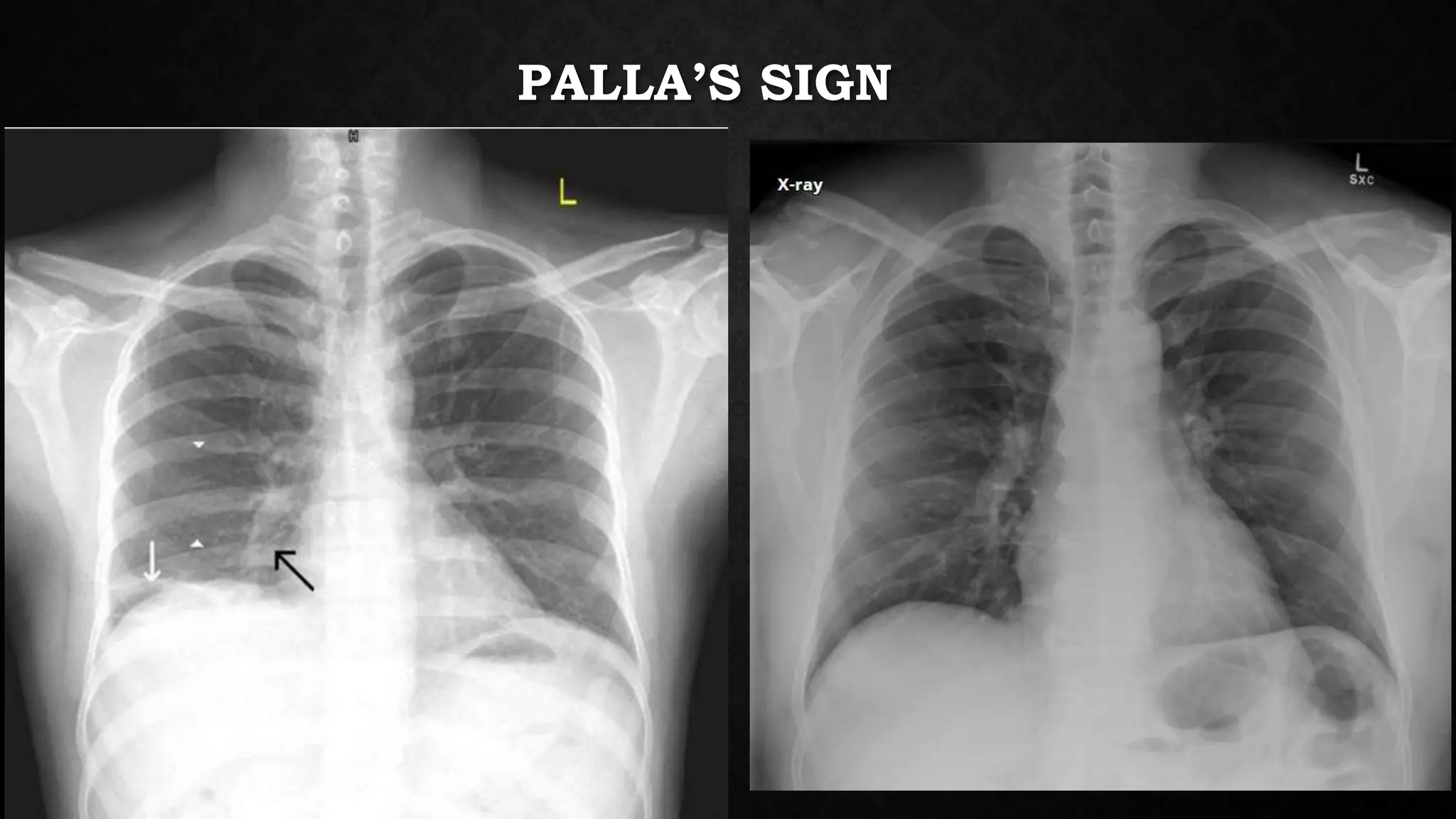 Pulmonary Embolism.pptx