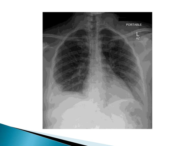 Pulmonary embolism.pptx by mcac rms ct findings | PPT
