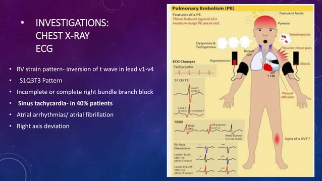 PULMONARY EMBOLISM.pptx and its management | PPT