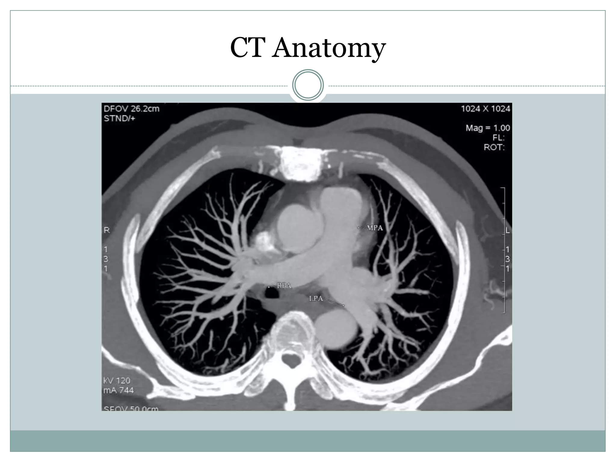 Pulmonary embolism radiology | PPTX