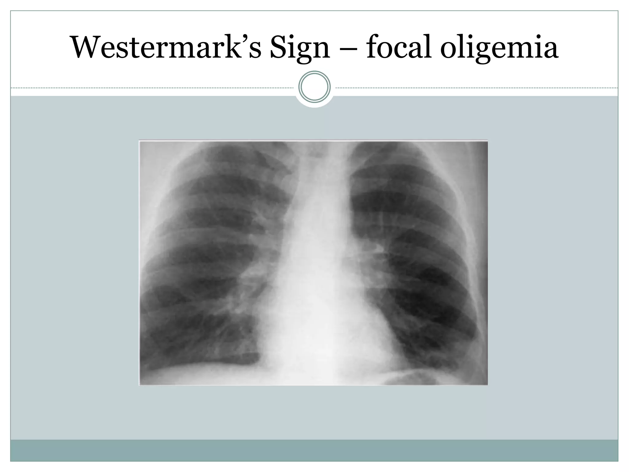 Pulmonary embolism radiology | PPTX