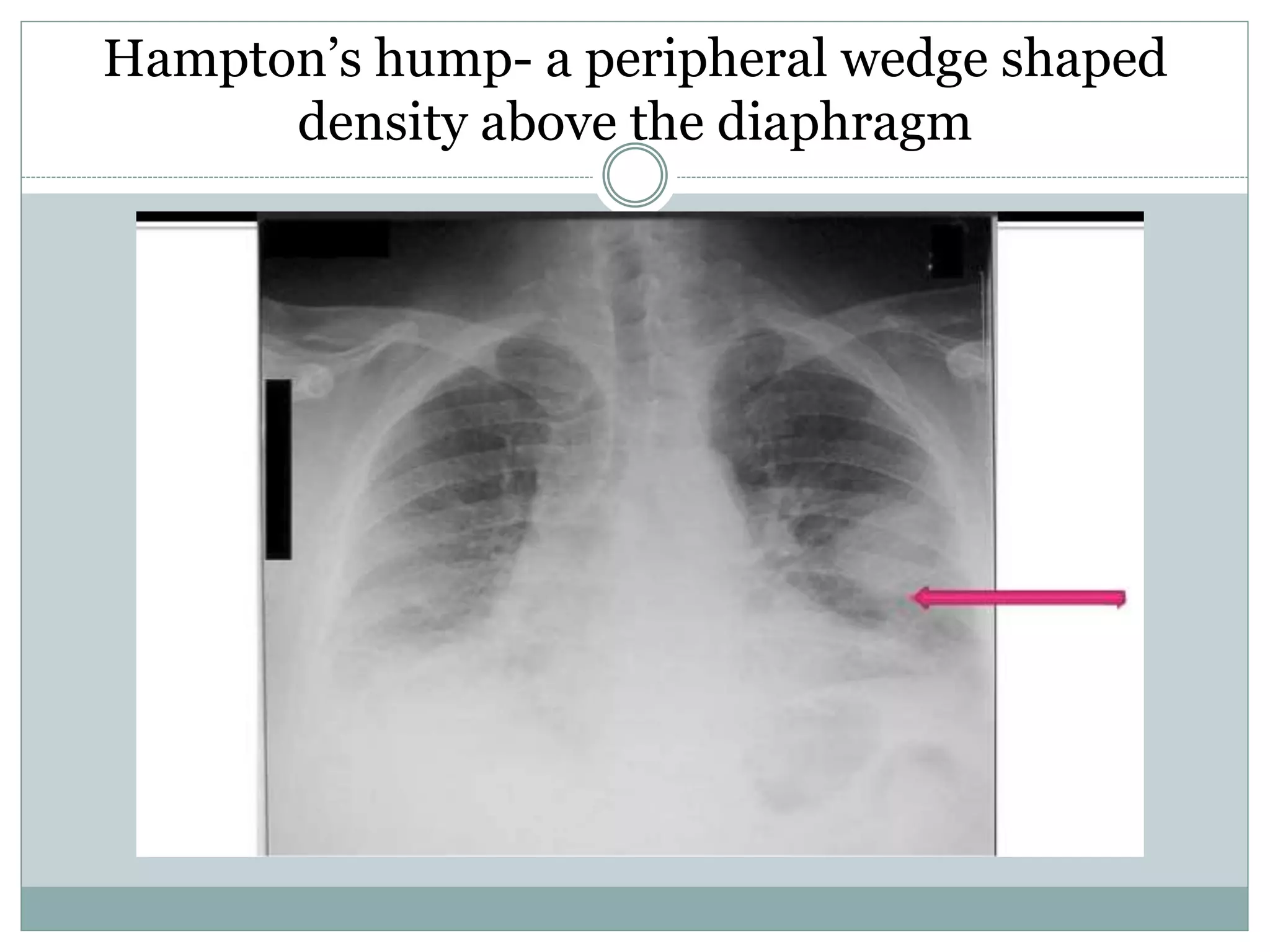Pulmonary embolism radiology | PPTX