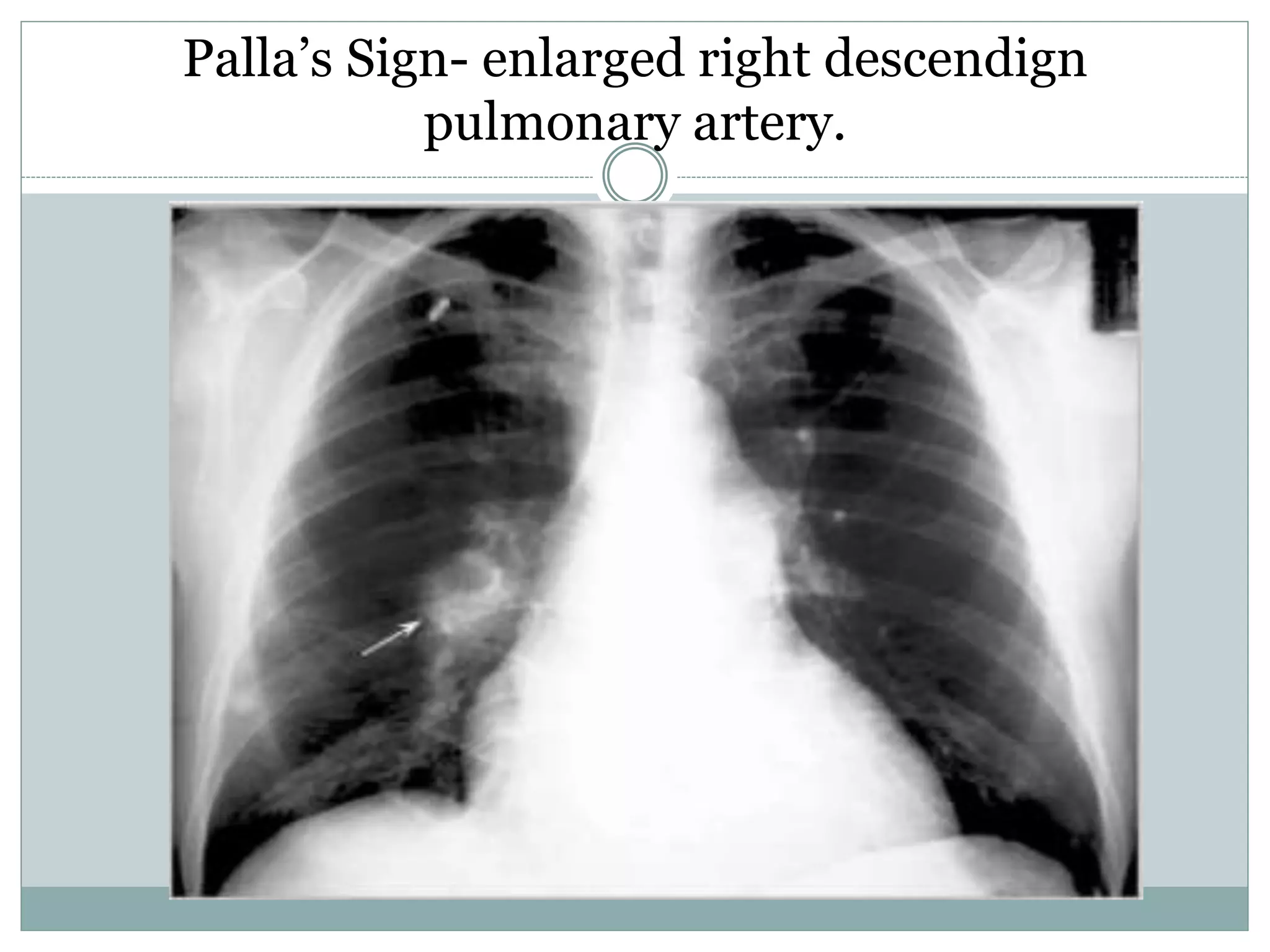 Pulmonary embolism radiology | PPTX