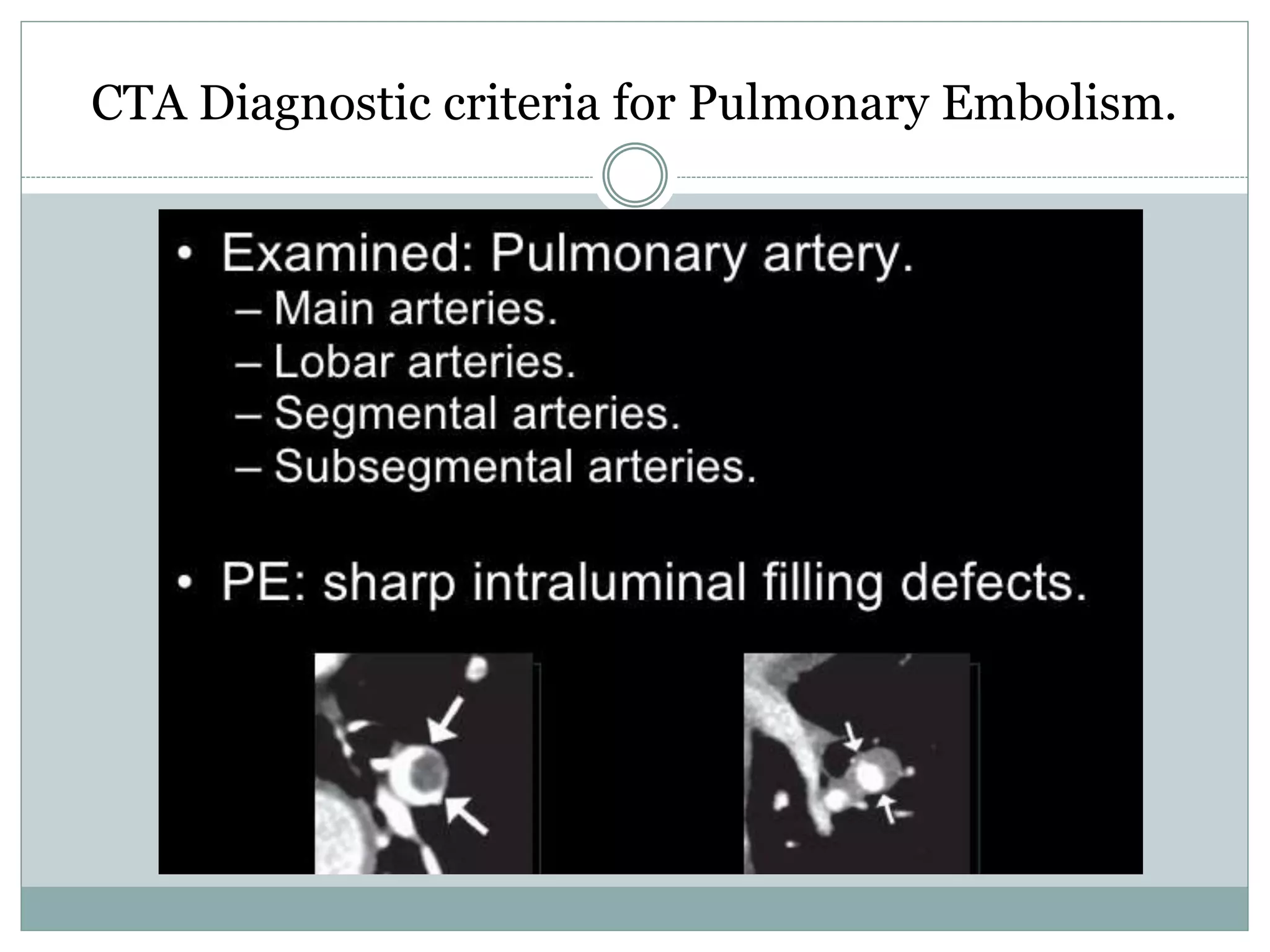 Pulmonary embolism radiology | PPTX