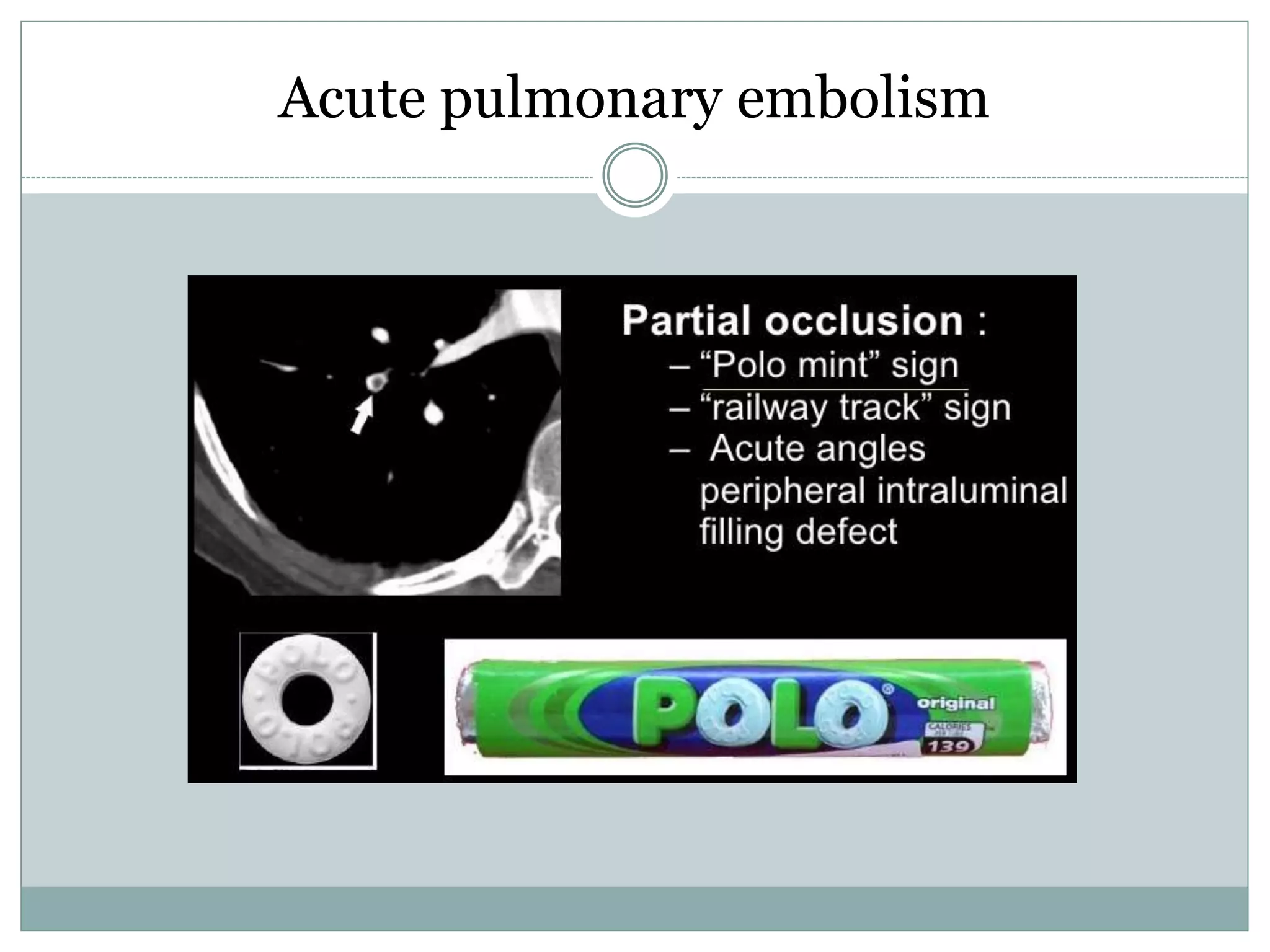 Pulmonary embolism radiology | PPTX