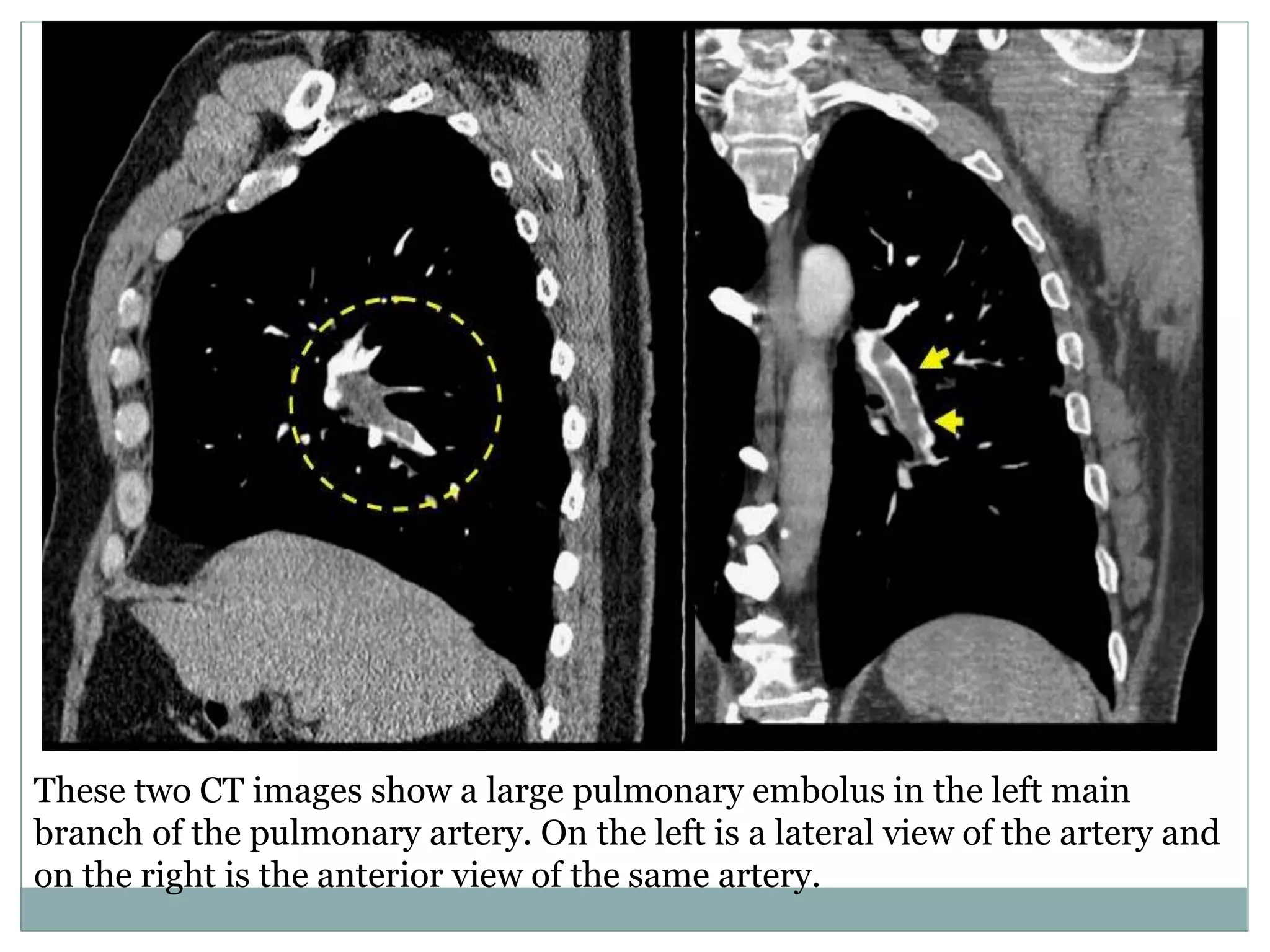 Pulmonary embolism radiology | PPTX