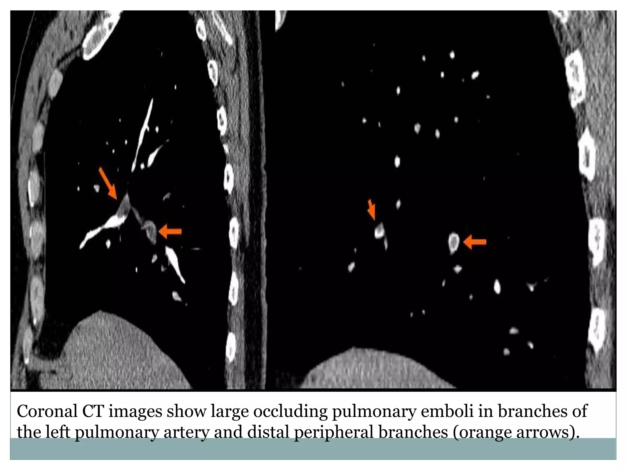 Pulmonary embolism radiology | PPTX