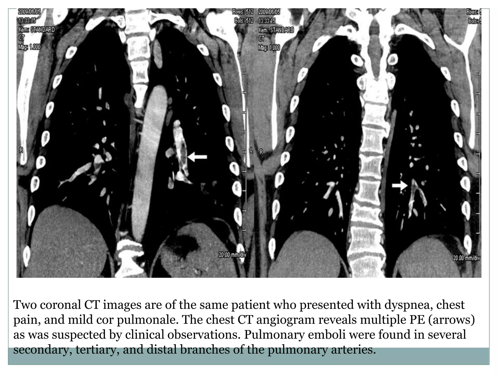 Pulmonary embolism radiology | PPTX