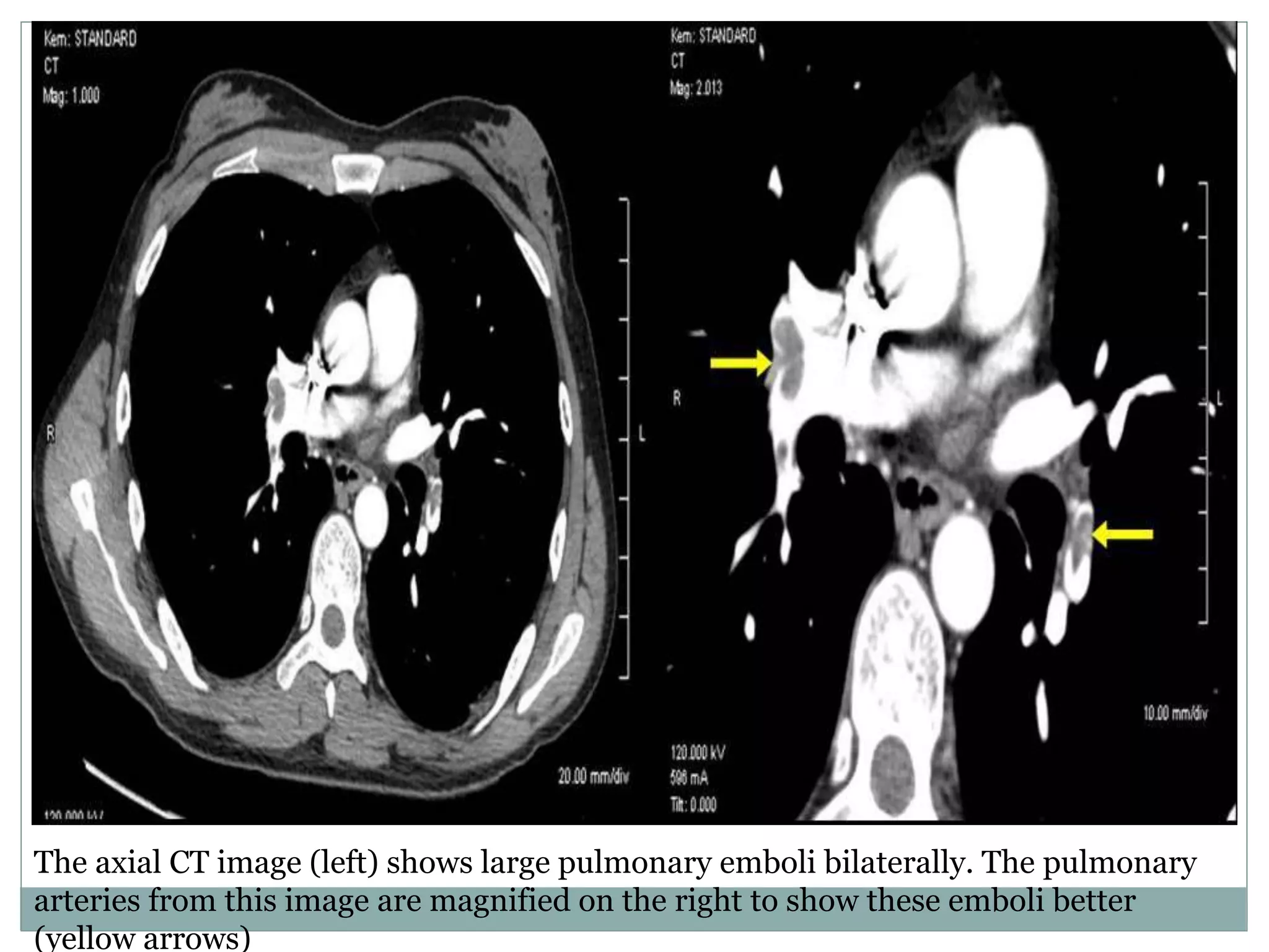 Pulmonary embolism radiology | PPTX