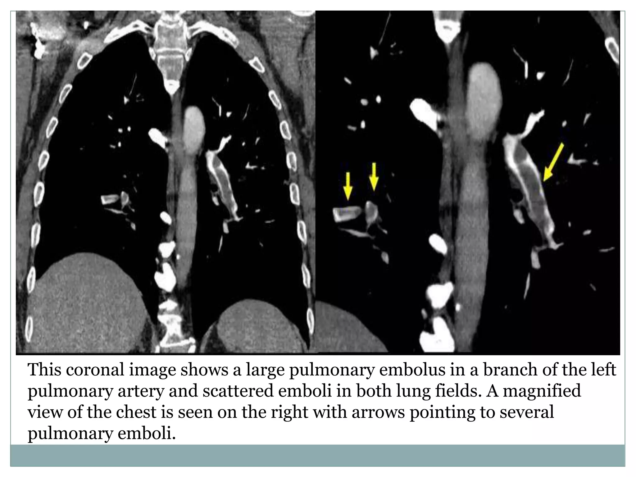 Pulmonary embolism radiology | PPTX