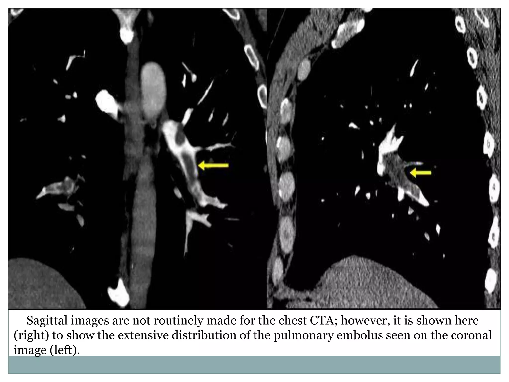 Pulmonary embolism radiology | PPTX