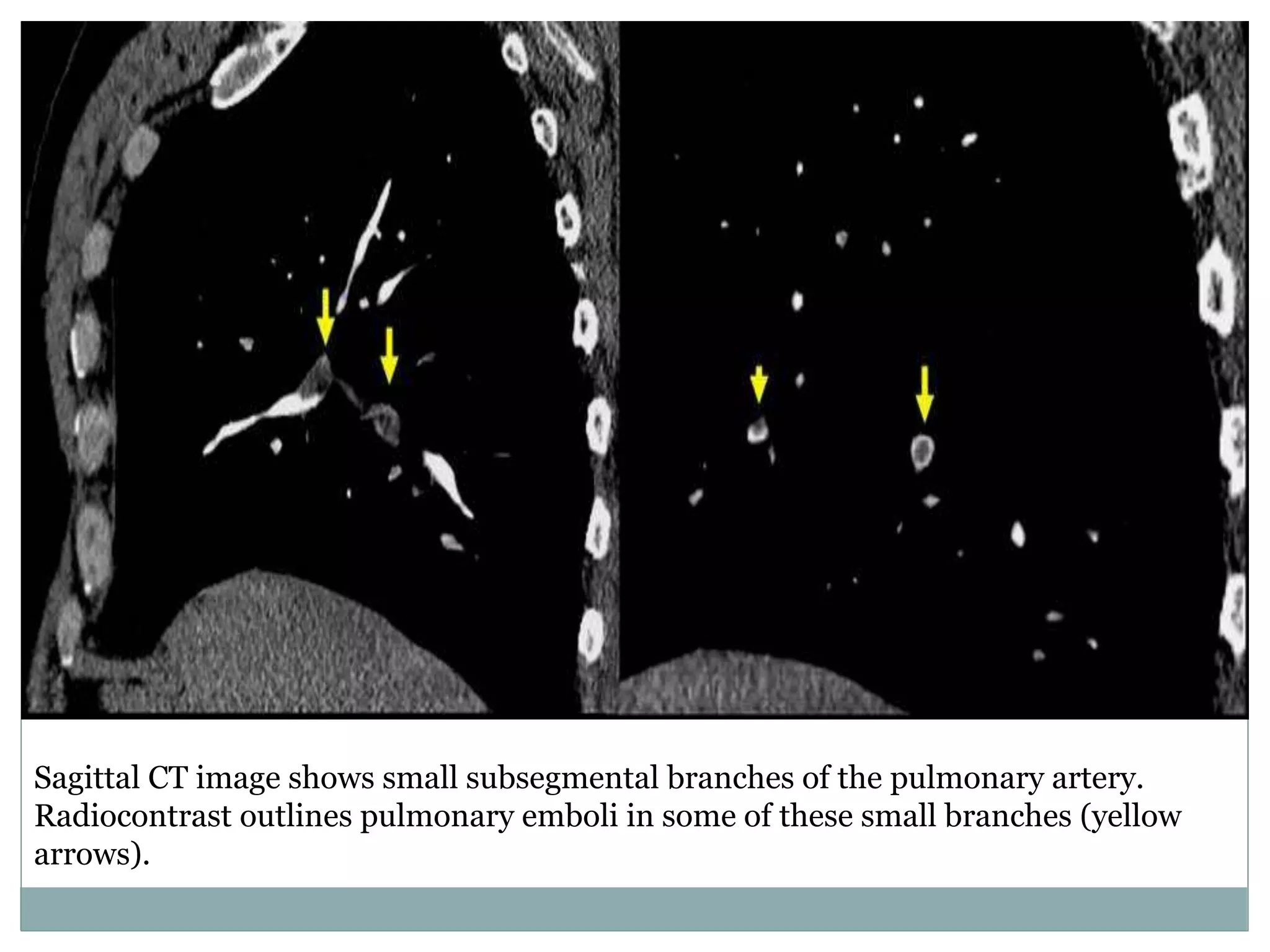 Pulmonary embolism radiology | PPTX