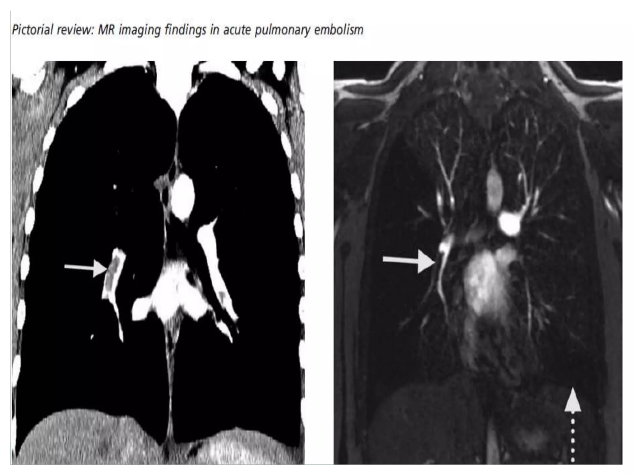 Pulmonary embolism radiology | PPTX