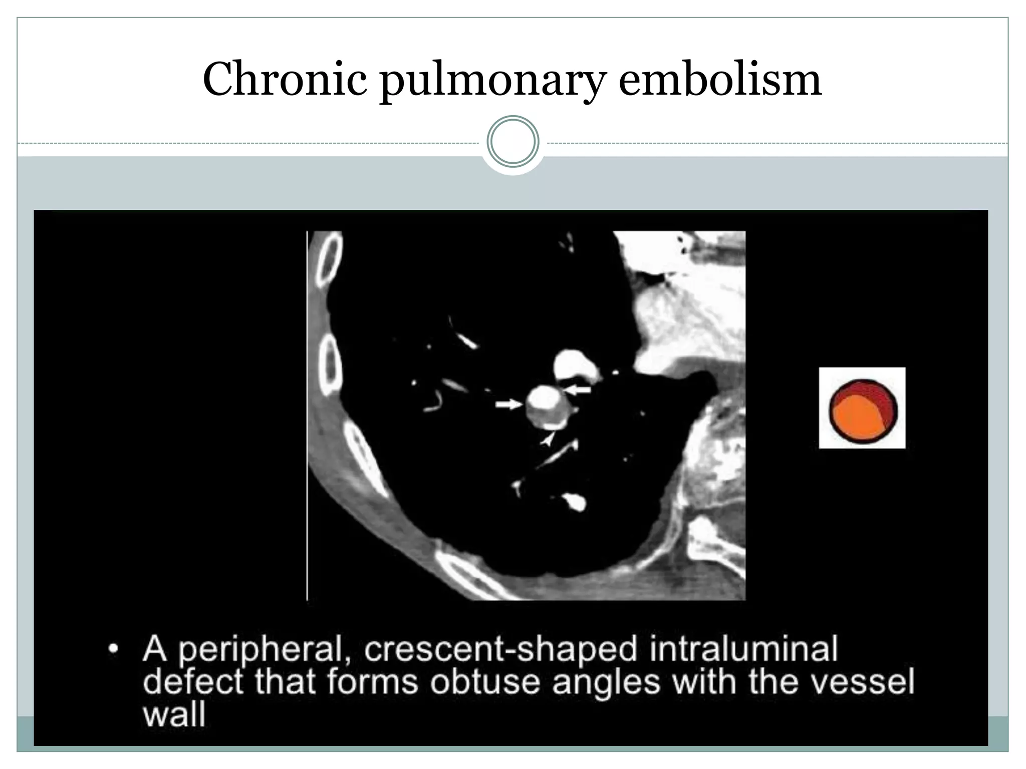 Pulmonary embolism radiology | PPTX