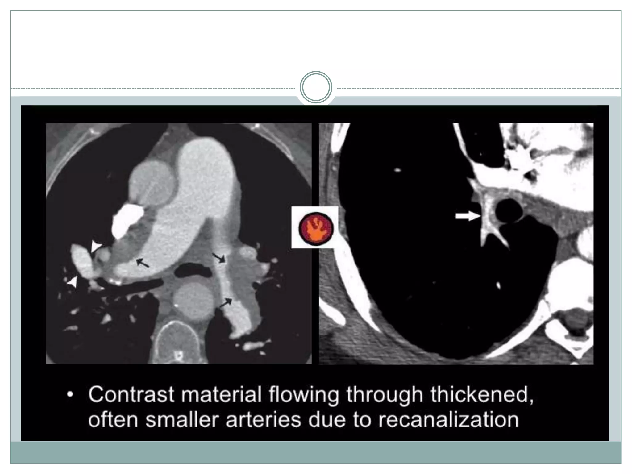 Pulmonary embolism radiology | PPTX