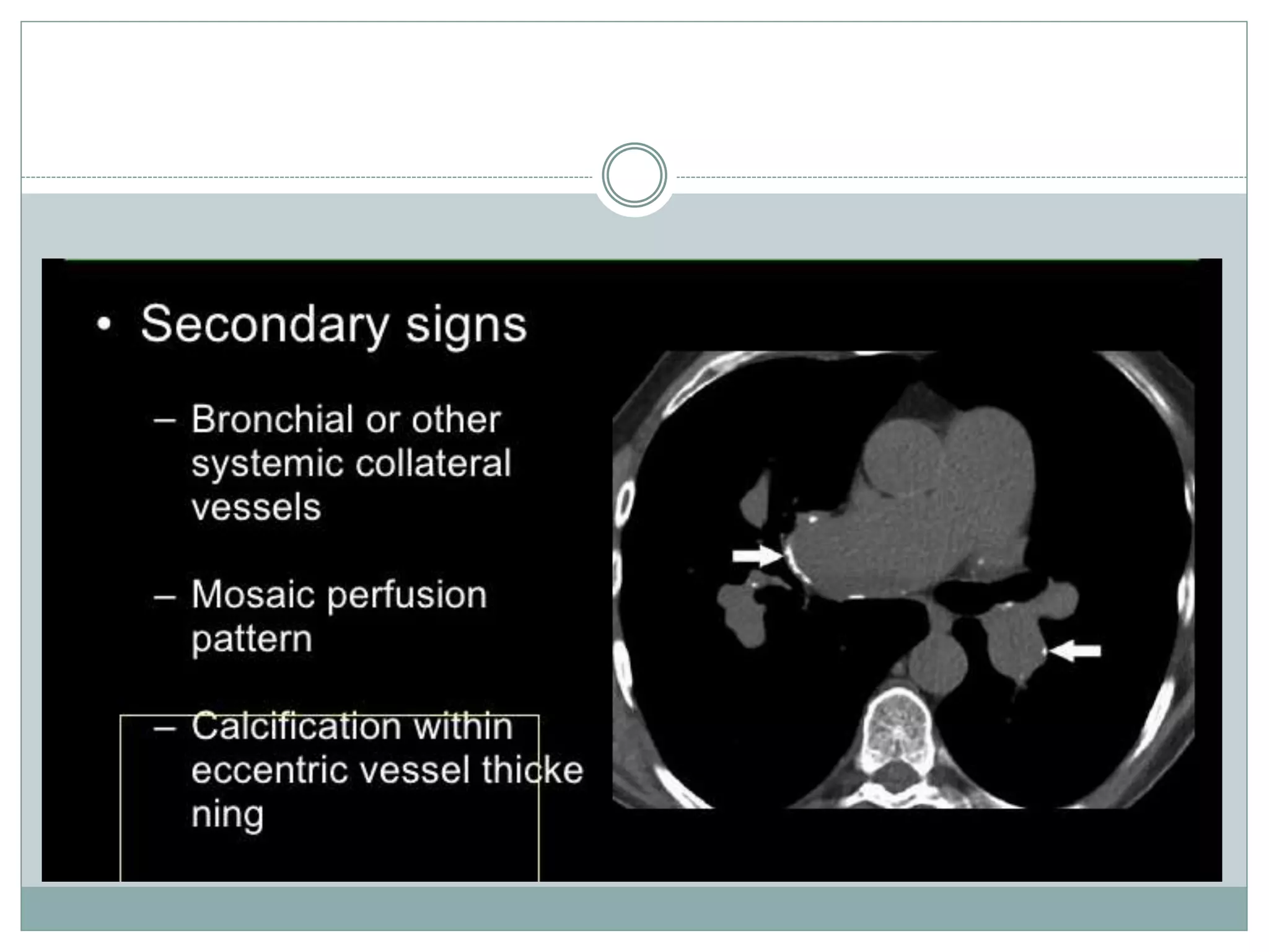 Pulmonary embolism radiology | PPTX