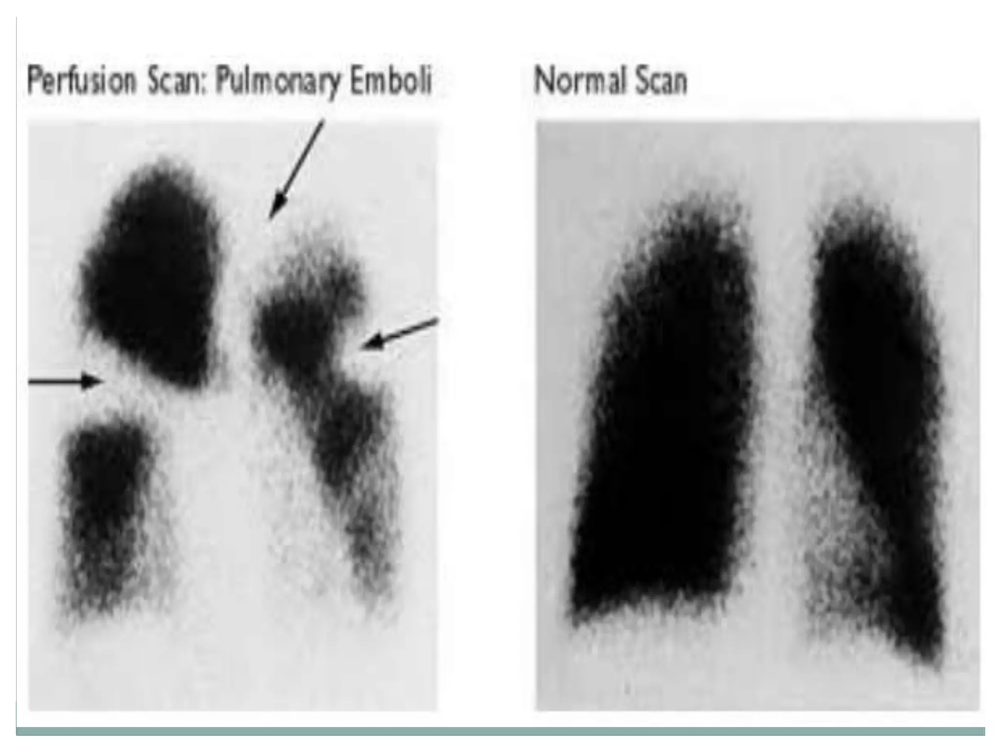 Pulmonary embolism radiology | PPTX