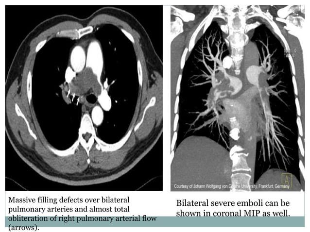 Pulmonary embolism radiology | PPTX