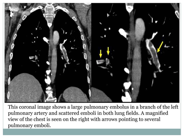 Pulmonary embolism radiology | PPTX