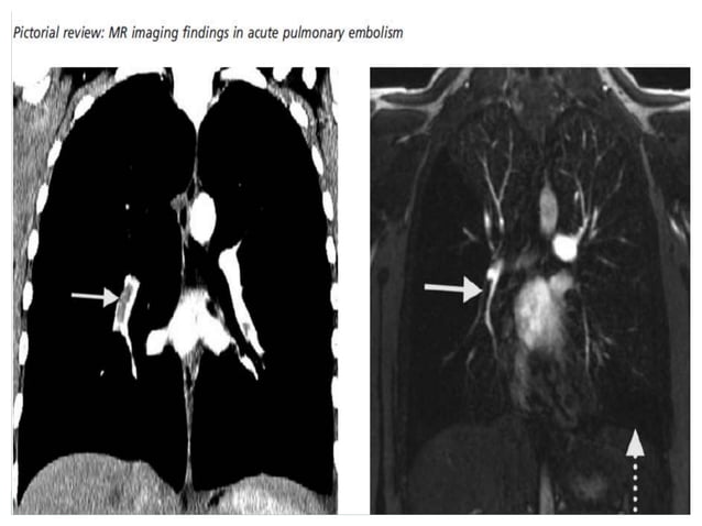 Pulmonary Embolism Radiology Ppt